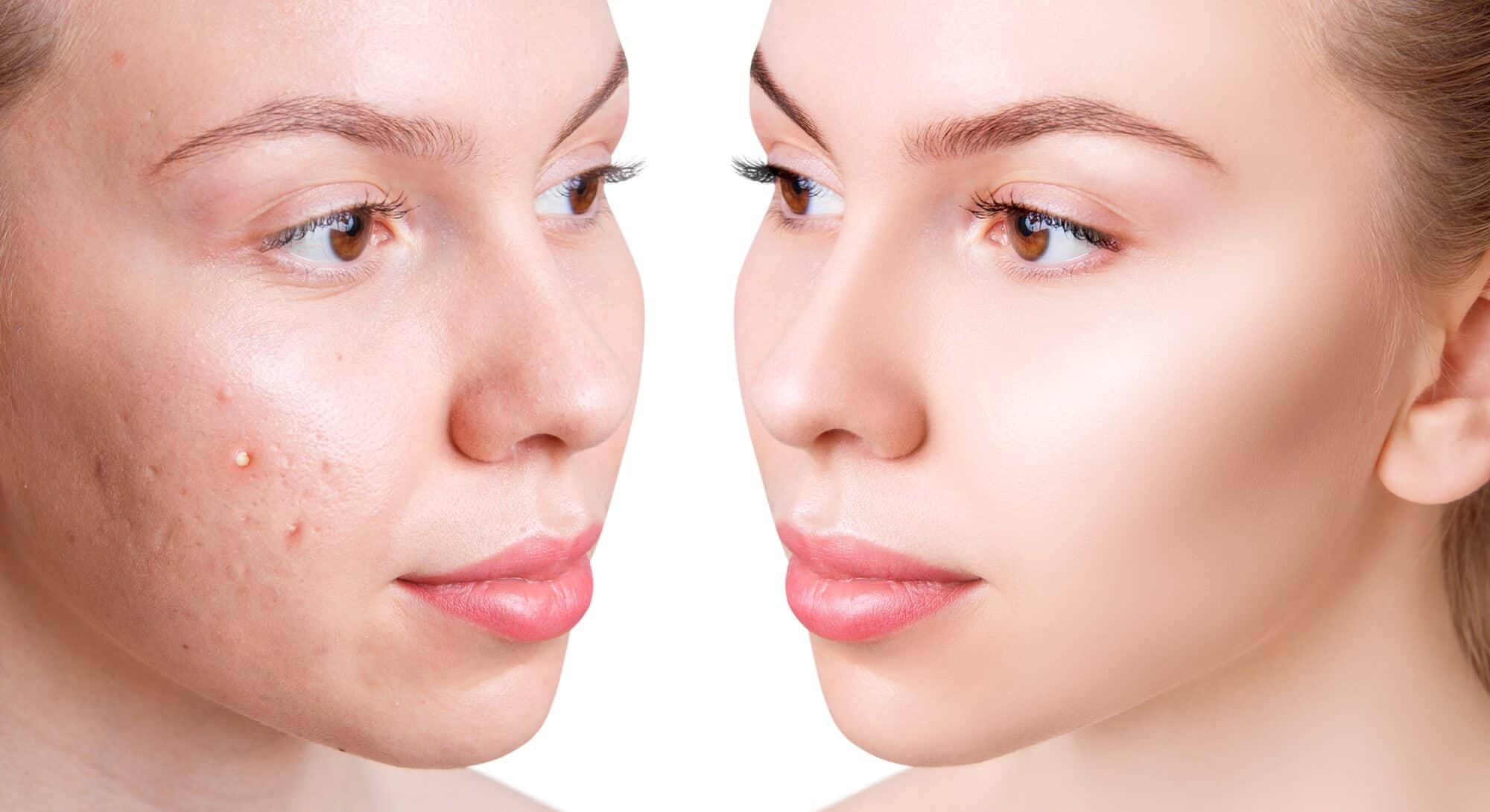 Scar Reduction Treatment in Portage & St. Joseph, MI